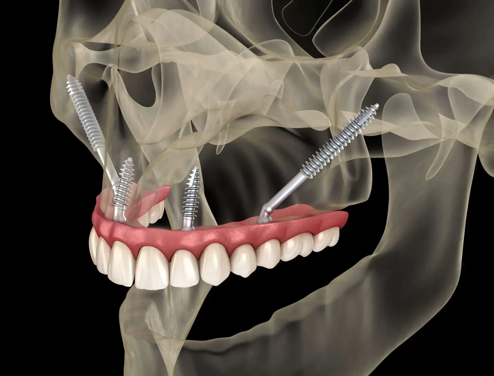 What are zygomatic implants and the ZAGA Concept?